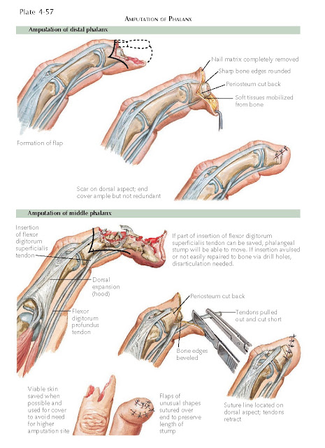 AMPUTATION IN THE HAND - pediagenosis
