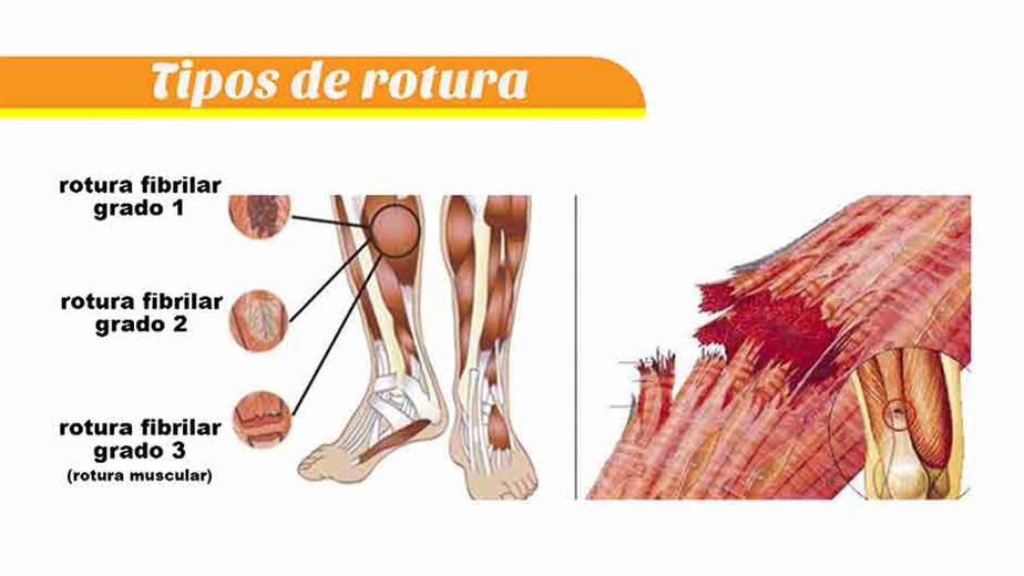 Lesiones Musculo esqueléticas y Lesiones por temperatura : DESGARRES