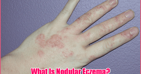 What Is Nodular Eczema? | Nutrition And Exercises For Gaining Muscle Mass