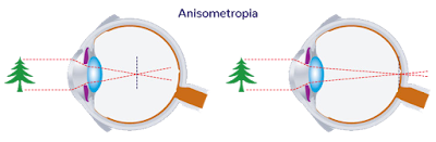 Anisometropic Refraction