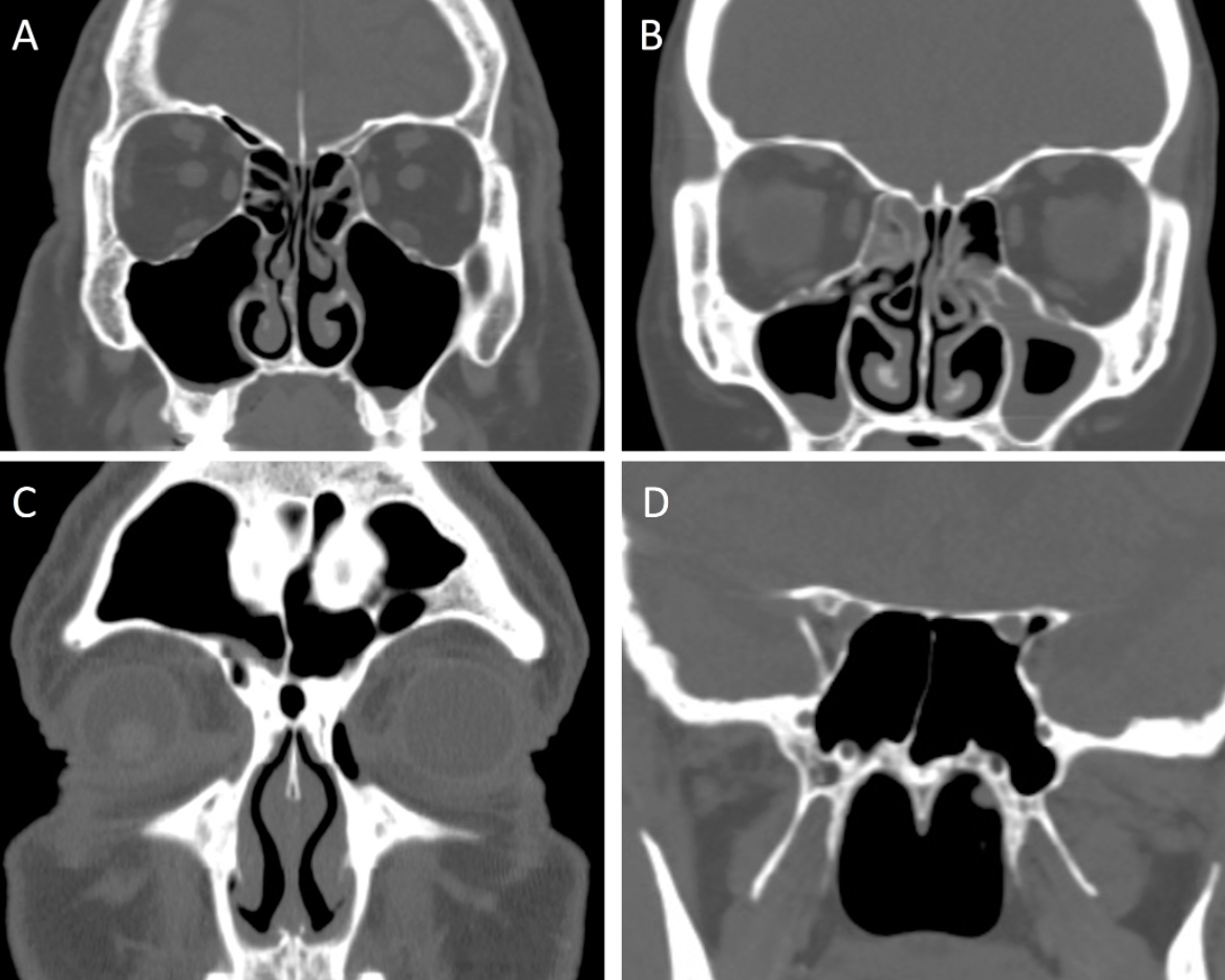 Ali Ghahary's Blogspot: Chronic Sinusitis