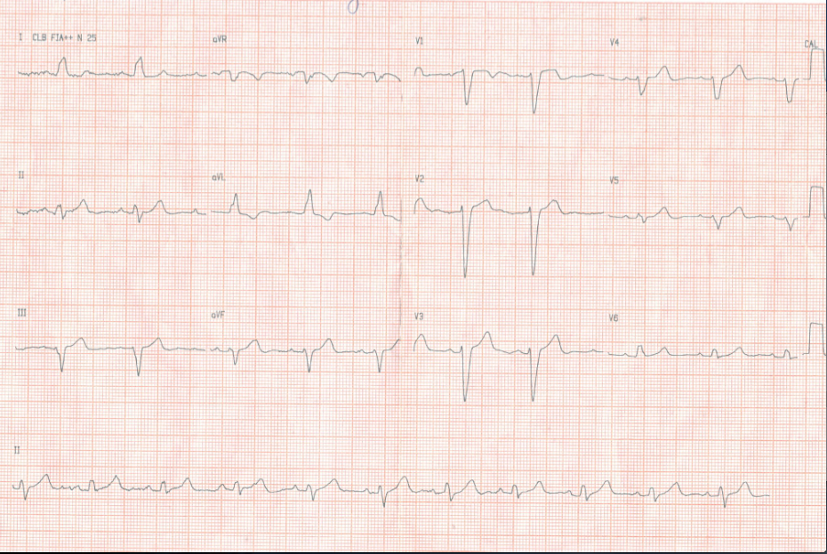 Blog de Eletrocardiografia: BRE E FUNÇÃO VENTRICULAR: ESCORE ...