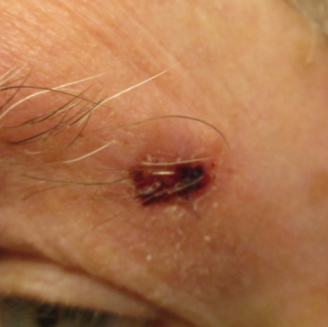 Jayaruh's Blog: Skin Cancer