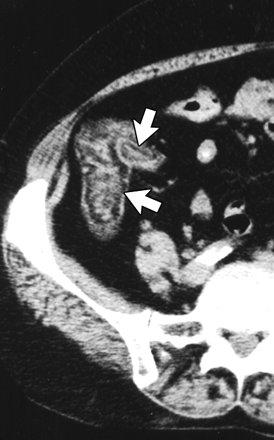 Ultimate Radiology : Causes of CT Bowel Fat Halo Sign