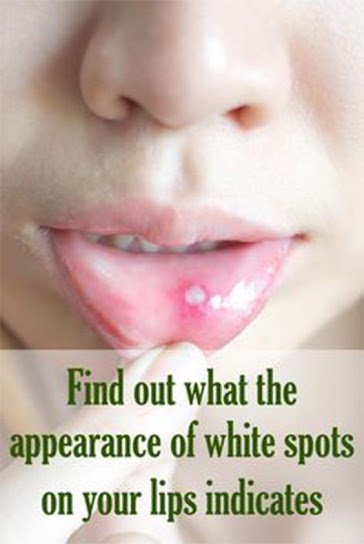 7 Best Tips to treat White Spots on Lips - medicine health life