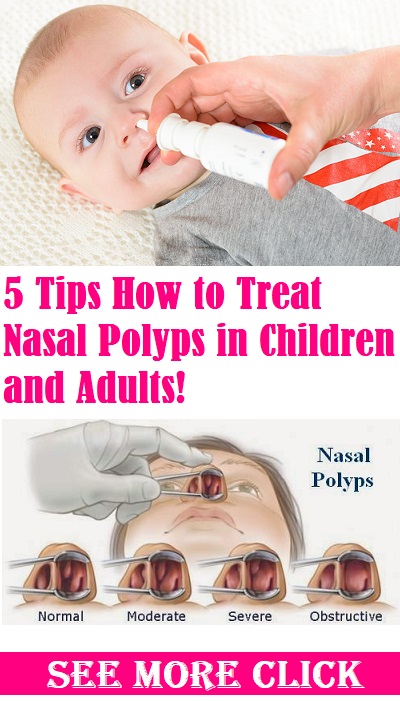 5 Tips How to Treat Nasal Polyps in Children and Adults!