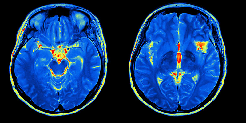 NEUROIMAGING IN IDENTIFYING DISORDERS