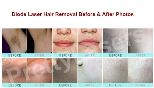 Germany Technology Portable Triple Wavelength Diode Laser Hair Removal ...