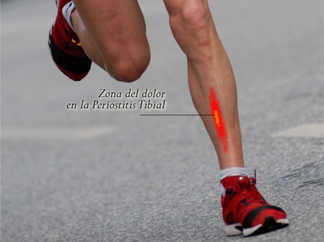 Rendirse Jamas: Periostitis Tibial