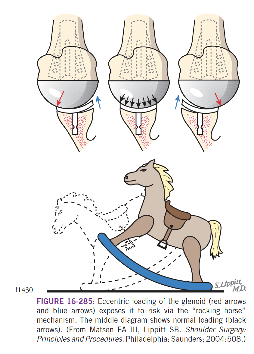 Shoulder Arthritis / Joint Replacement : Glenoid component loosening ...