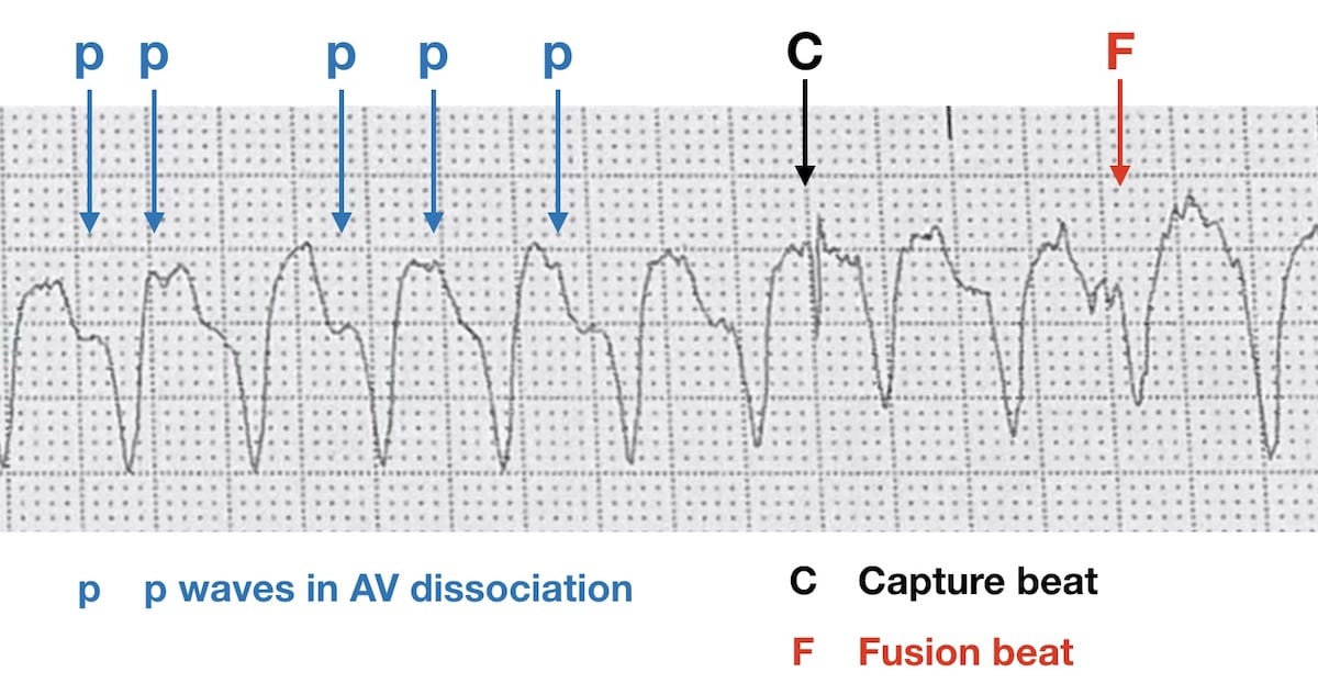 EKG, VENTRİKÜLER TAŞİKARDİ