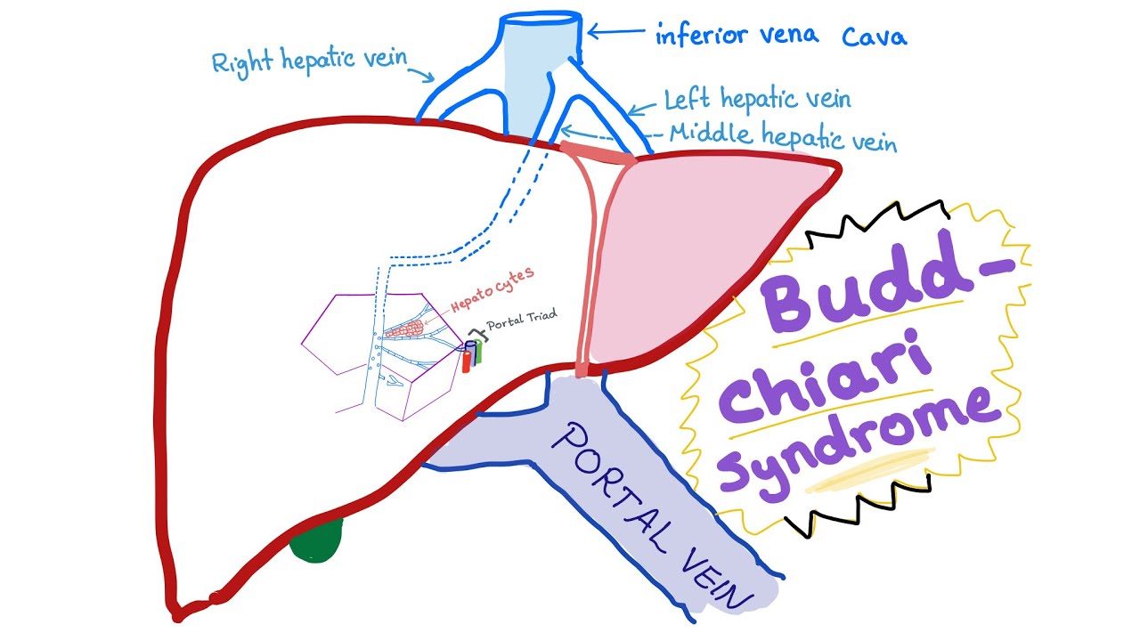 BUDD-CHIARI SYNDROME - Medical Yukti