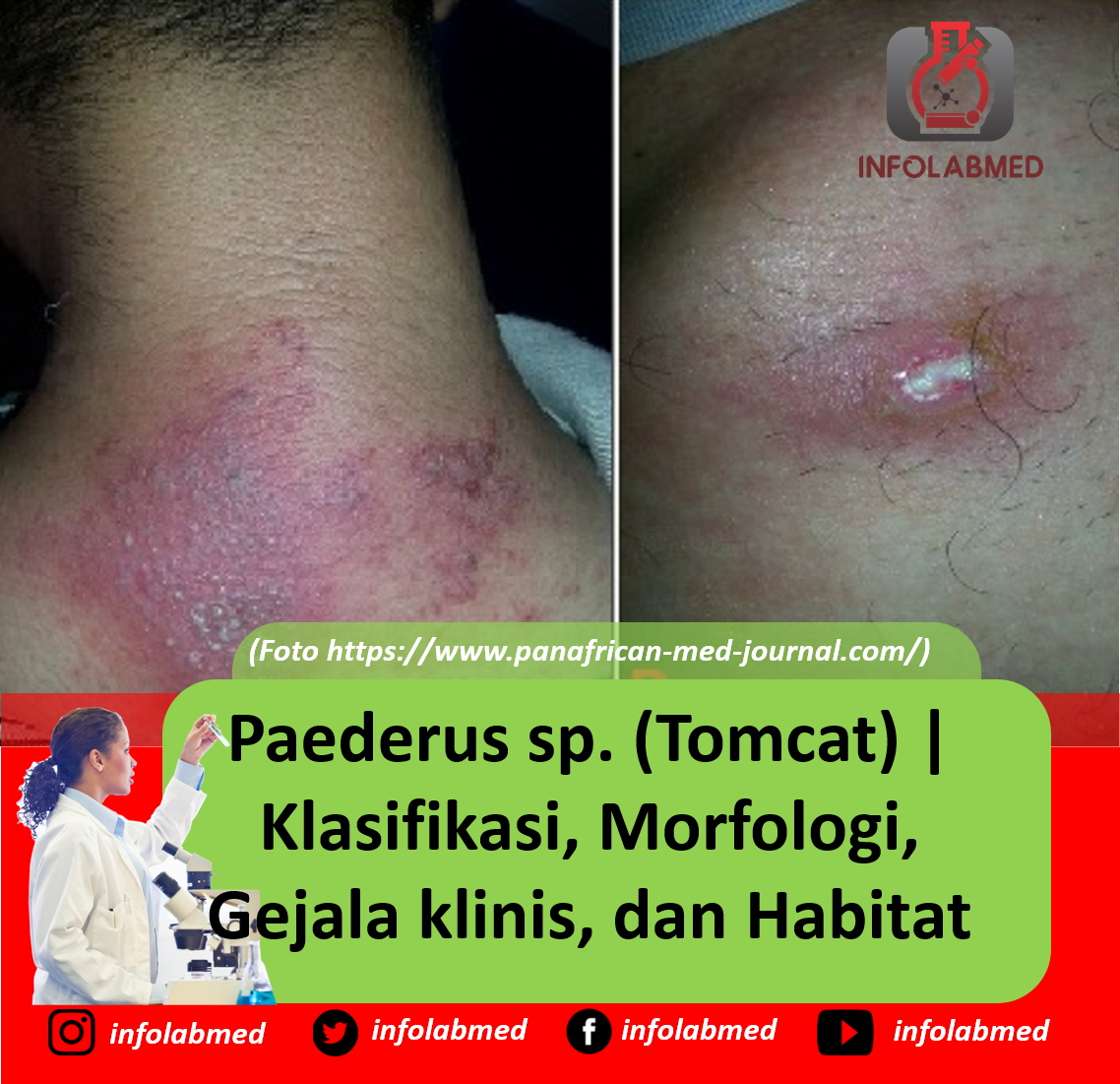 Paederus sp. (Tomcat) | Klasifikasi, Morfologi, Gejala klinis, dan Habitat