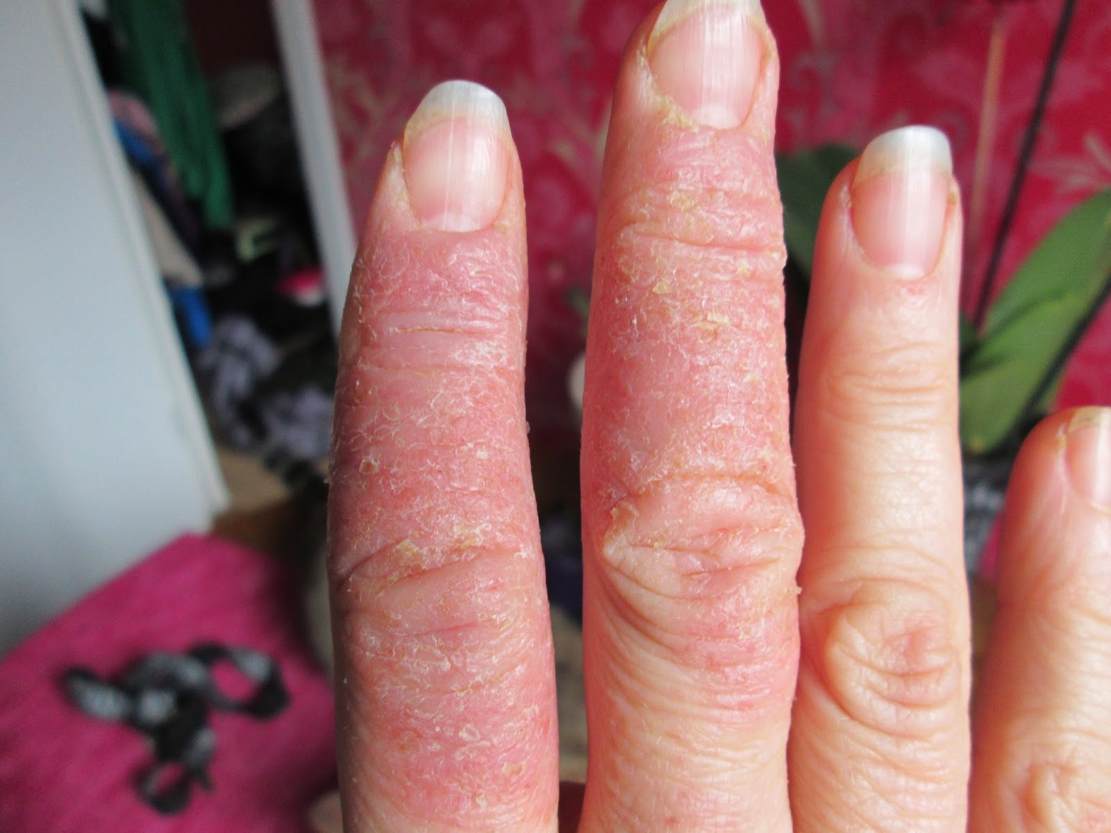 Min kropp och jag talar inte samma språk: Akupunktur & Ayurveda mot eksem