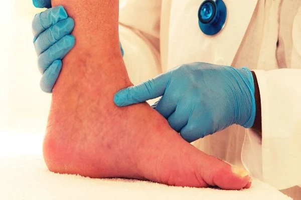 Difference between Pitting Edema and Non-Pitting Edema