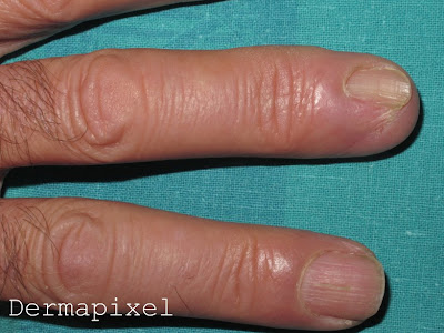 Dermapixel: abril 2013