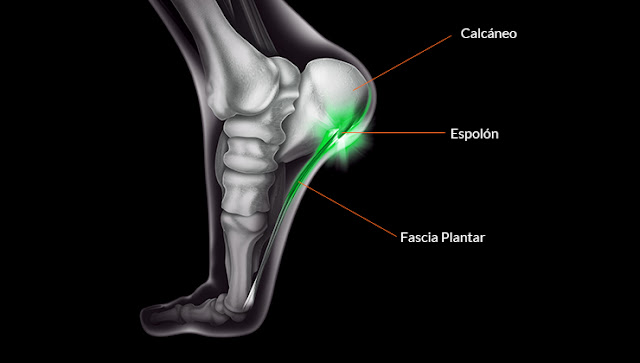 4 Ejercicios para tratar el espolón calcáneo - Tu WikiGuia