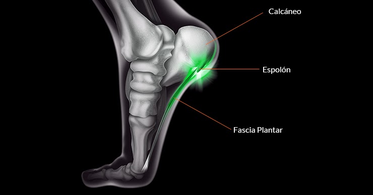 4 Ejercicios para tratar el espolón calcáneo - Tu WikiGuia