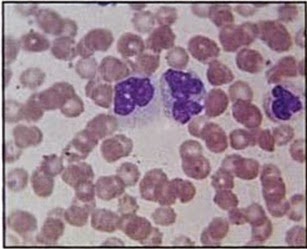 Células importantes en hematología: MONOCITOSIS
