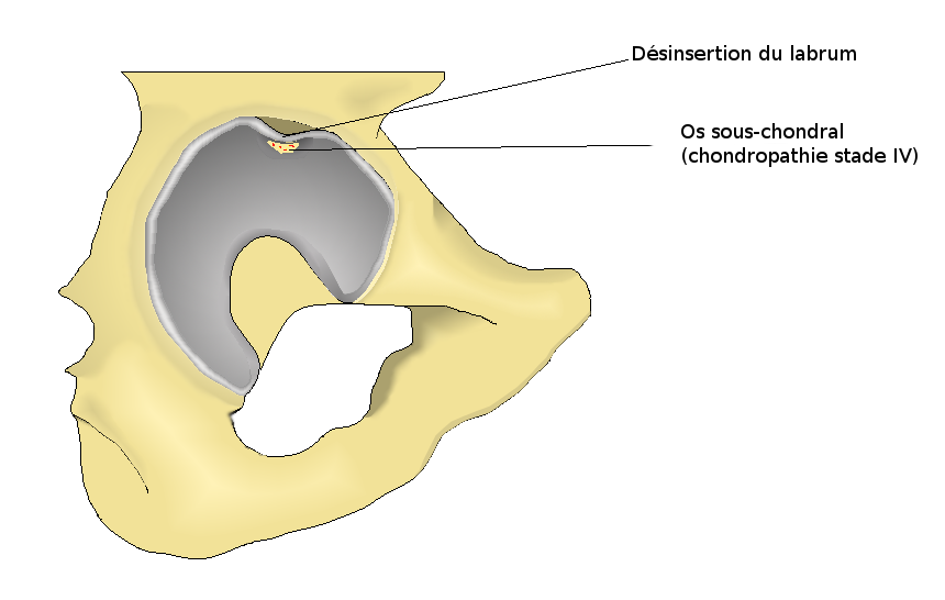 Conflit de Hanche: Est-il possible de réparer le cartilage