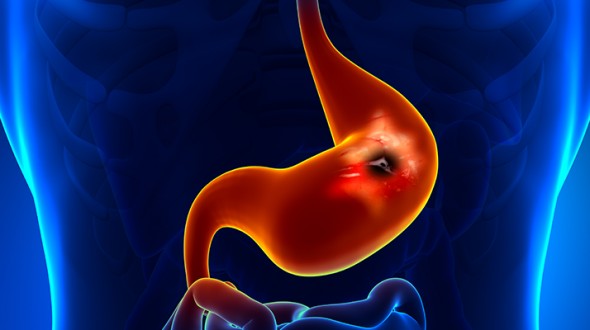 STOMACH ULCERS AND DUODENAL ULCERS ~ Alcohol