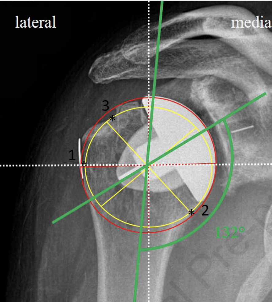 Shoulder Arthritis/Joint Replacement Rotator cuff tears: Stemless ...