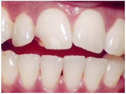 Ellis and Davey Classification - Endodontics and Oral Implantology