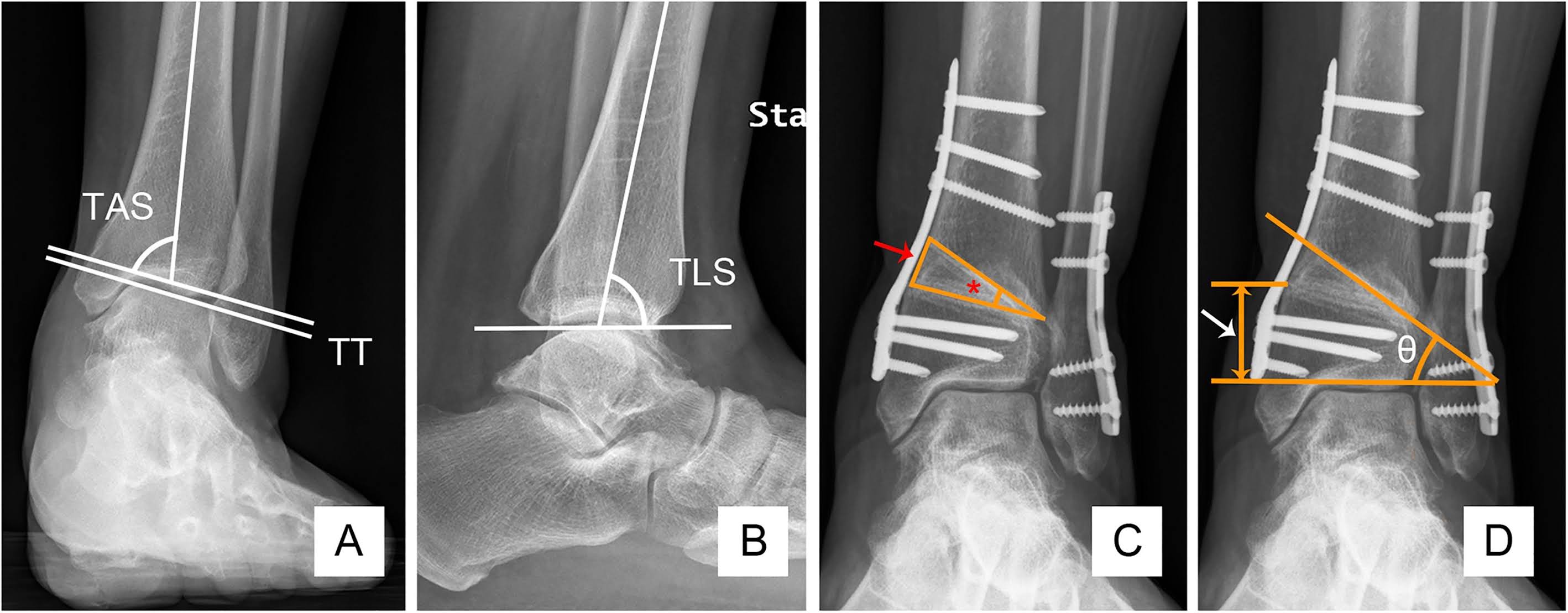 Revisiones_bibliográficas TyO_Web: El efecto de la osteotomía ...