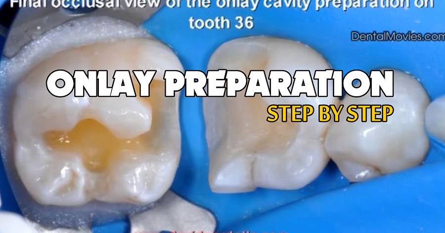 ONLAY PREPARATION: On tooth 36 with distal margin coronal relocation ...