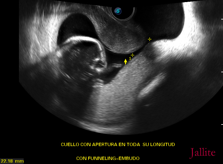 Incompetencia Cervical