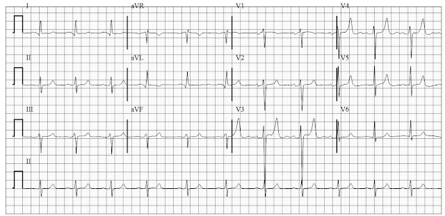 ECG Case: A 60 year old woman with history of chronic kidney disease ...