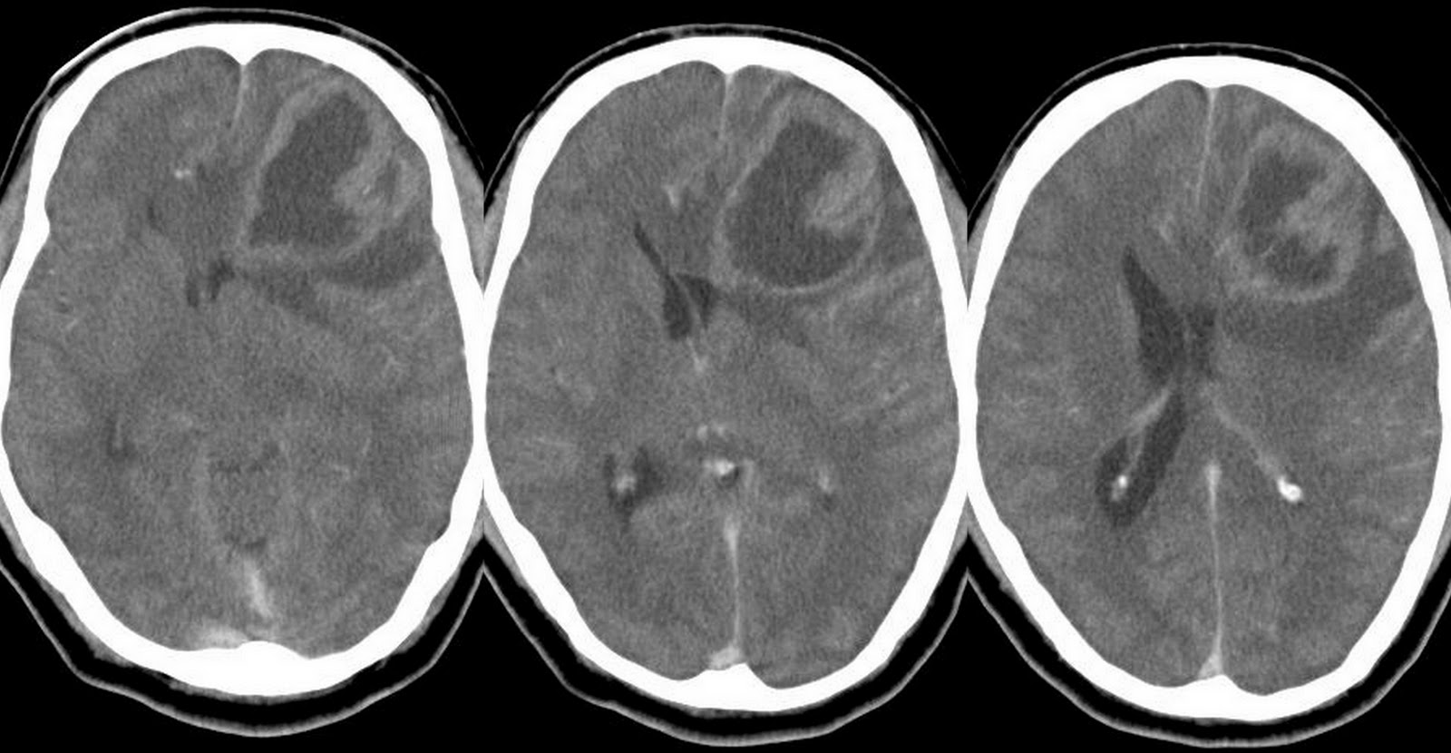 Dr Balaji Anvekar FRCR: Glioblastoma multiforme