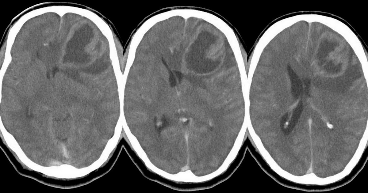 Dr Balaji Anvekar FRCR: Glioblastoma multiforme