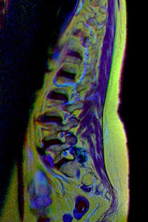 Nevit's blog: Color MRI of spine