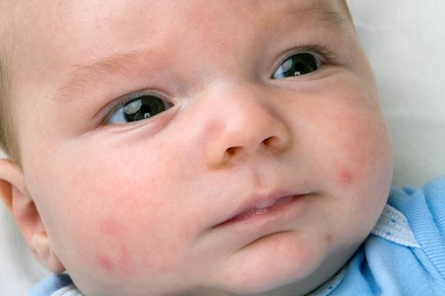 This is a problem in the baby's skin and how to overcome it