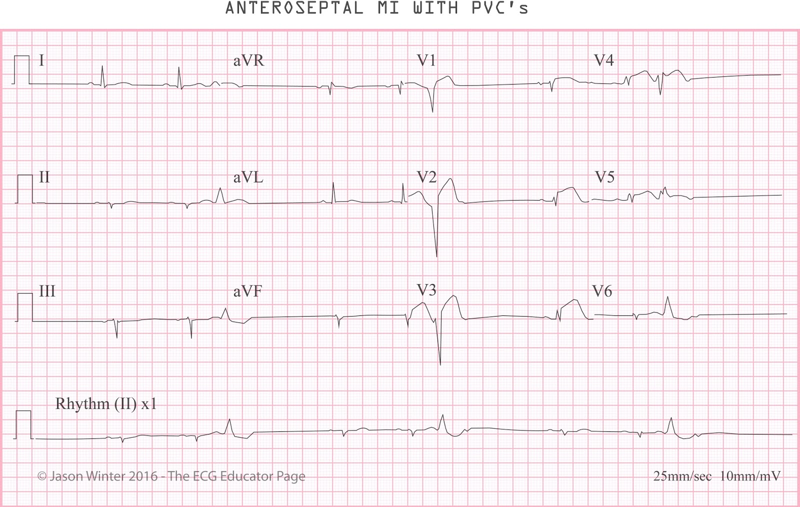 ECG Educator Blog : Acute coronary syndrome and infarctions