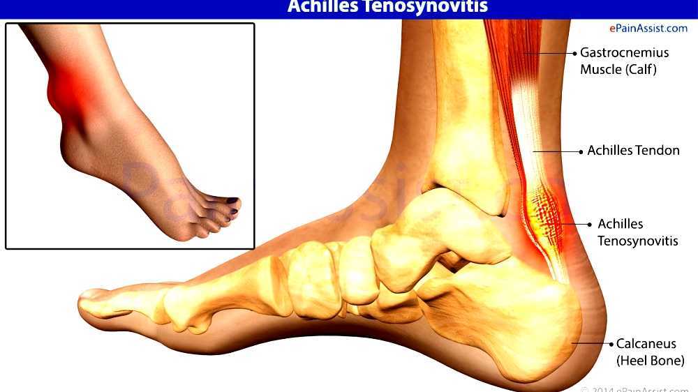 Tenosynovitis