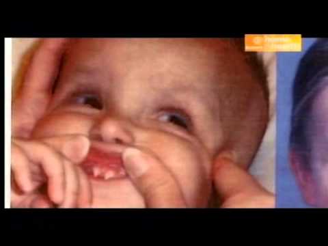 Elementos de Anatomía y Fisiología Humana: Deficiencia Gen Nemo