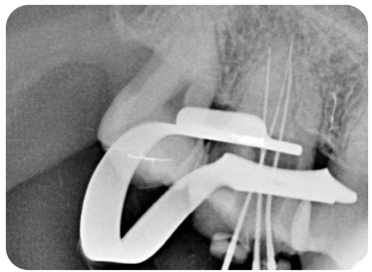 Caso Clínico Master: Conducto en C ¿También en molares superiores?