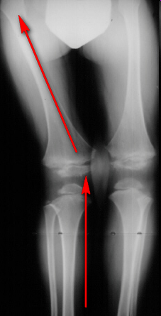 The Fascia Therapy Blog: Effects of Load-Bearing in Cerebral Palsy: Bones