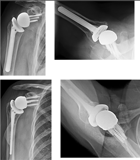 UW Shoulder and Elbow Academy: Reverse total shoulder: avoiding notching