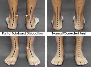 HyProCure®: Relief of Foot Pain & Increased Foot Function with ...