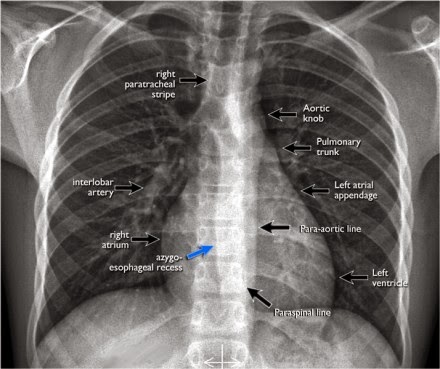 Chest Medicine Made Easy-Dr Deepu: Chest X Ray Part 1- Normal Anatomy ...