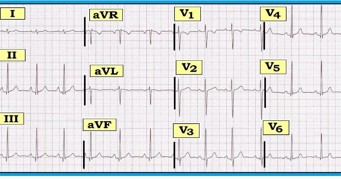 ECG Interpretation: ECG Blog #75 — LAA vs LAE vs Not ...