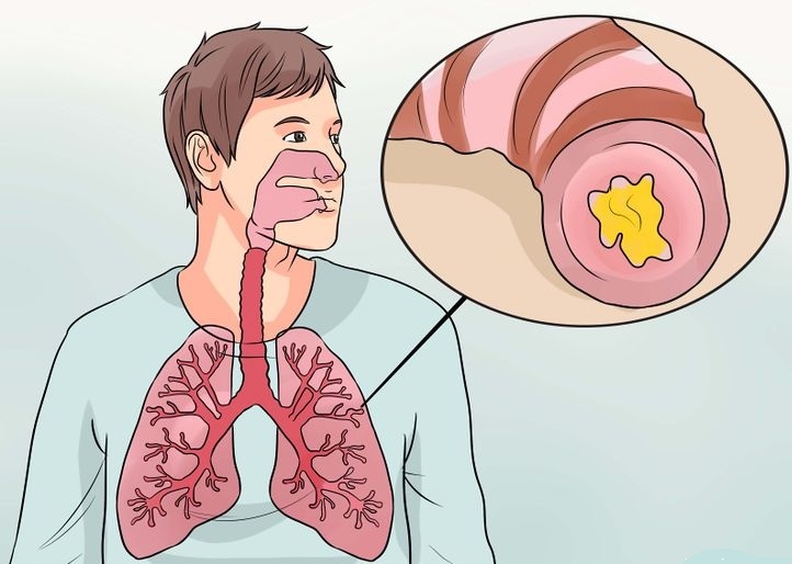 ELIMINA LA TOS EN LOS NIÑOS Y ADULTOS ~ MUNDO DE LOCURAZ