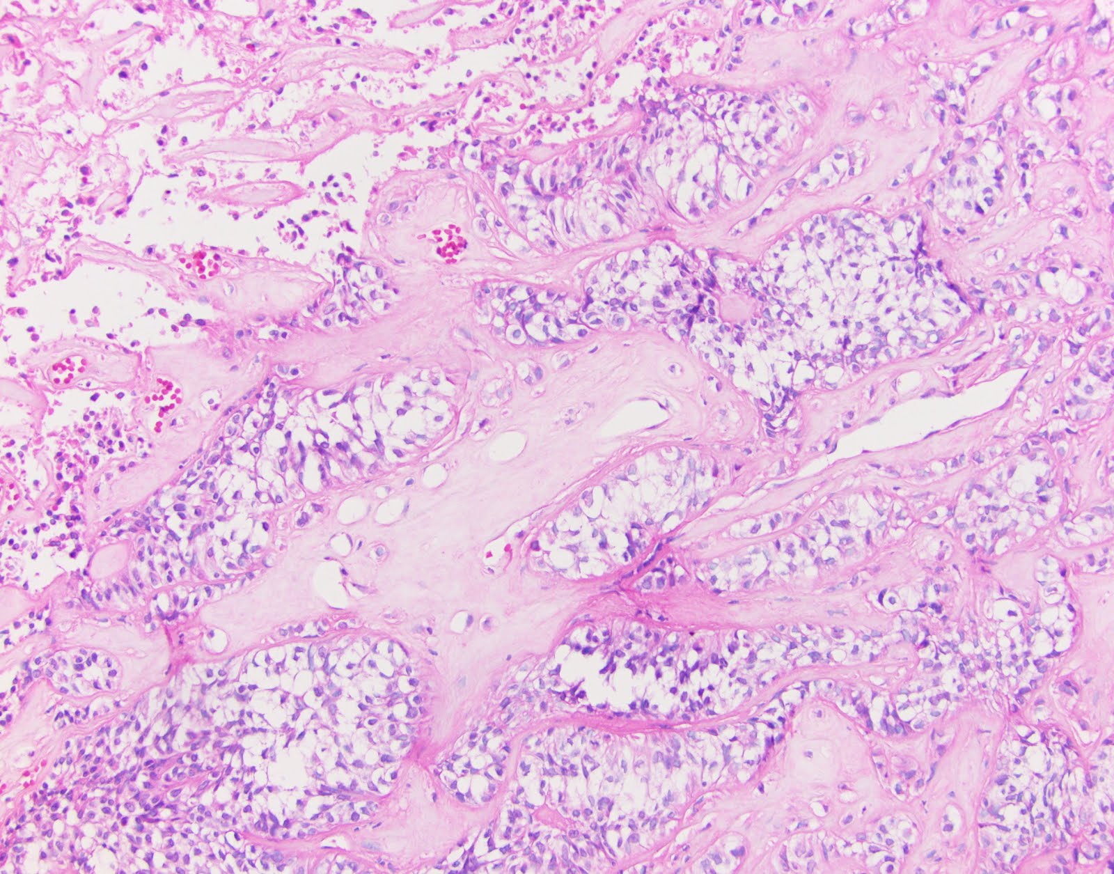 neuropathology blog: Astroblastoma