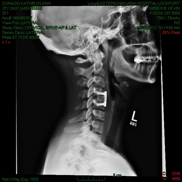 My Post Concussion Syndrome: 4 Weeks Post Op ACDF