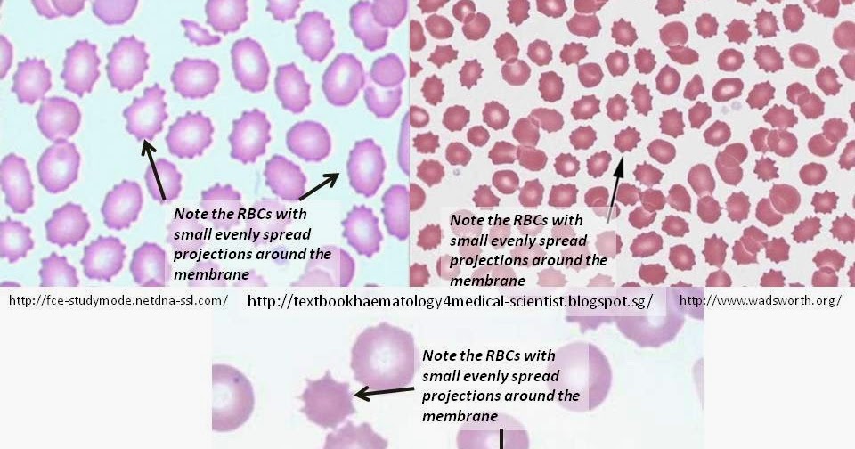 Haematology in a NutShell: Crenated RBCs (Echinocytes)