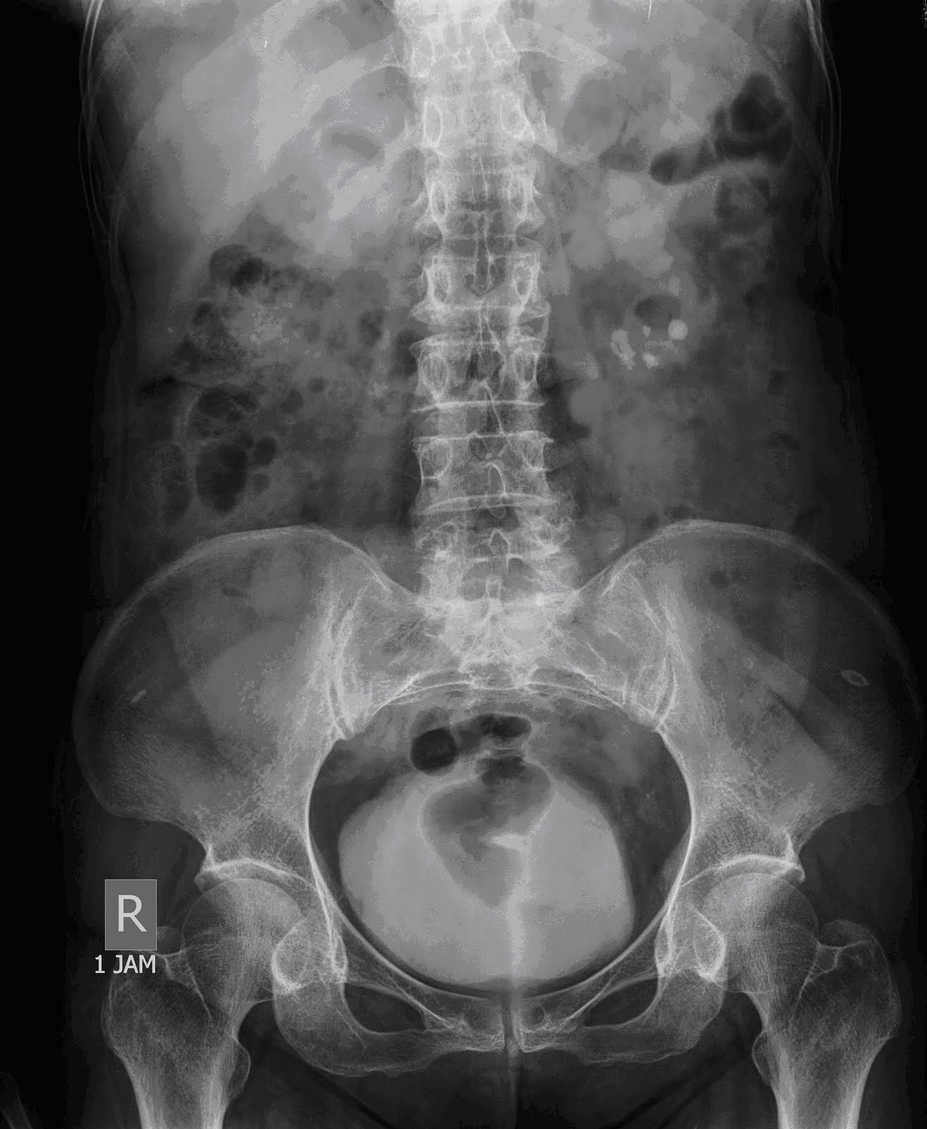 Dasar-Dasar Radiologi : Foto BNO-IVP - Catatan Dokter