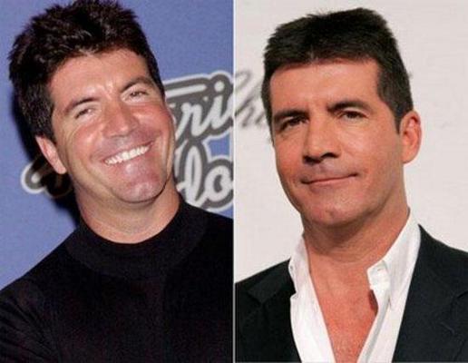Simon Cowell Plastic Surgery